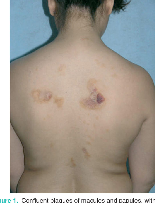 Nodular Amyloidosis