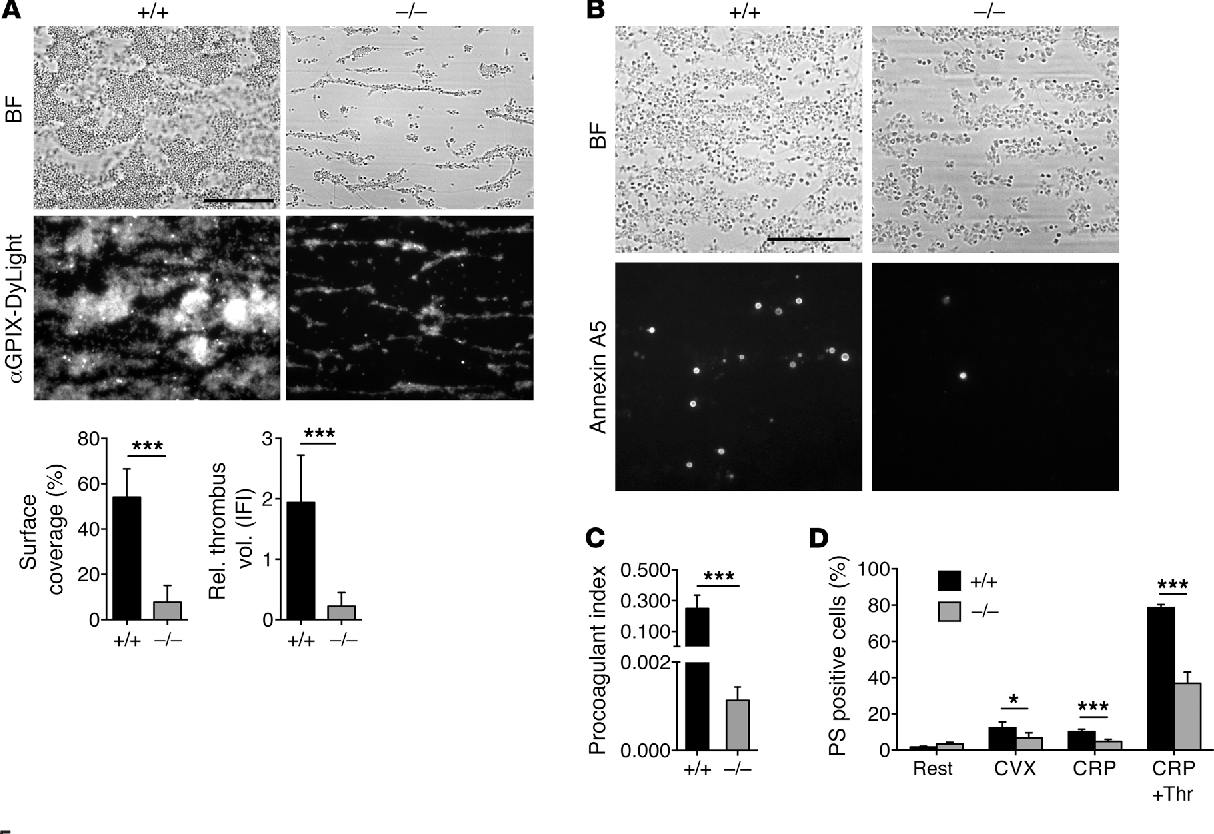 Figure 1 From Gray Platelet Syndrome And Defective Thrombo Inflammation