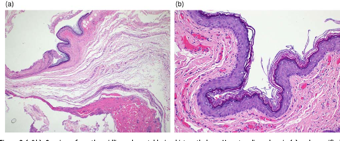 Epidermal Inclusion Cyst Histology