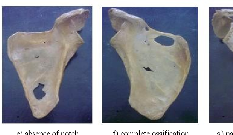 Figure 1 From Morphology And Morphometric Analysis Of Suprascapular