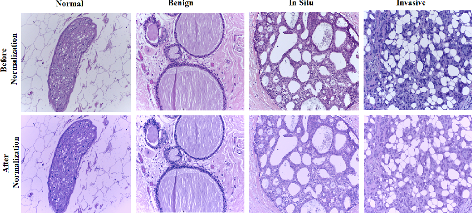 Pdf Classification Of Breast Cancer Histology Images Using Transfer