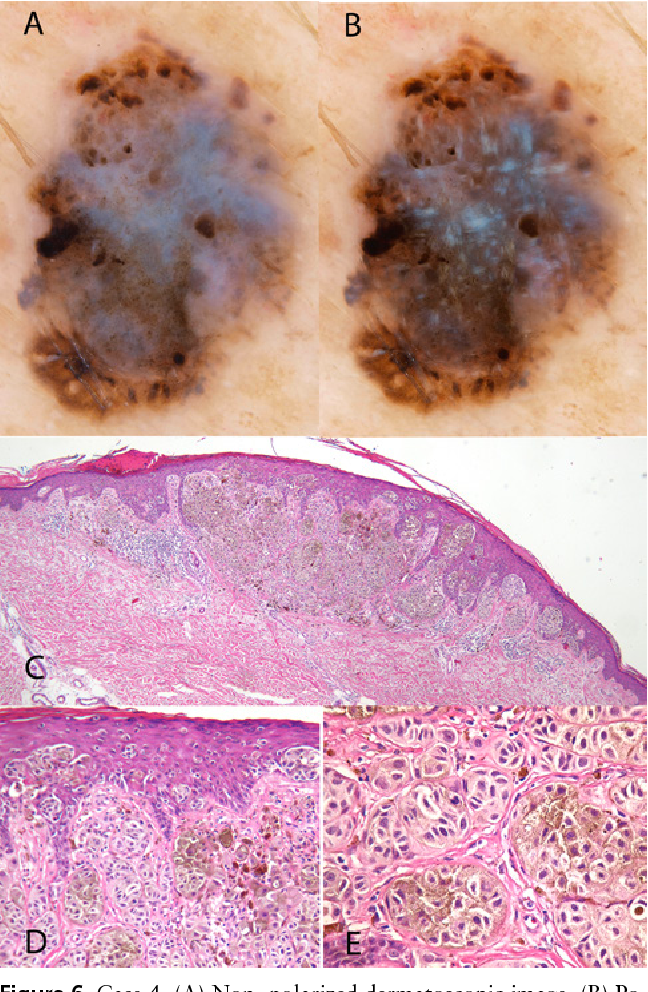 Figure 1 From Nodular Melanoma Five Consecutive Cases In A General