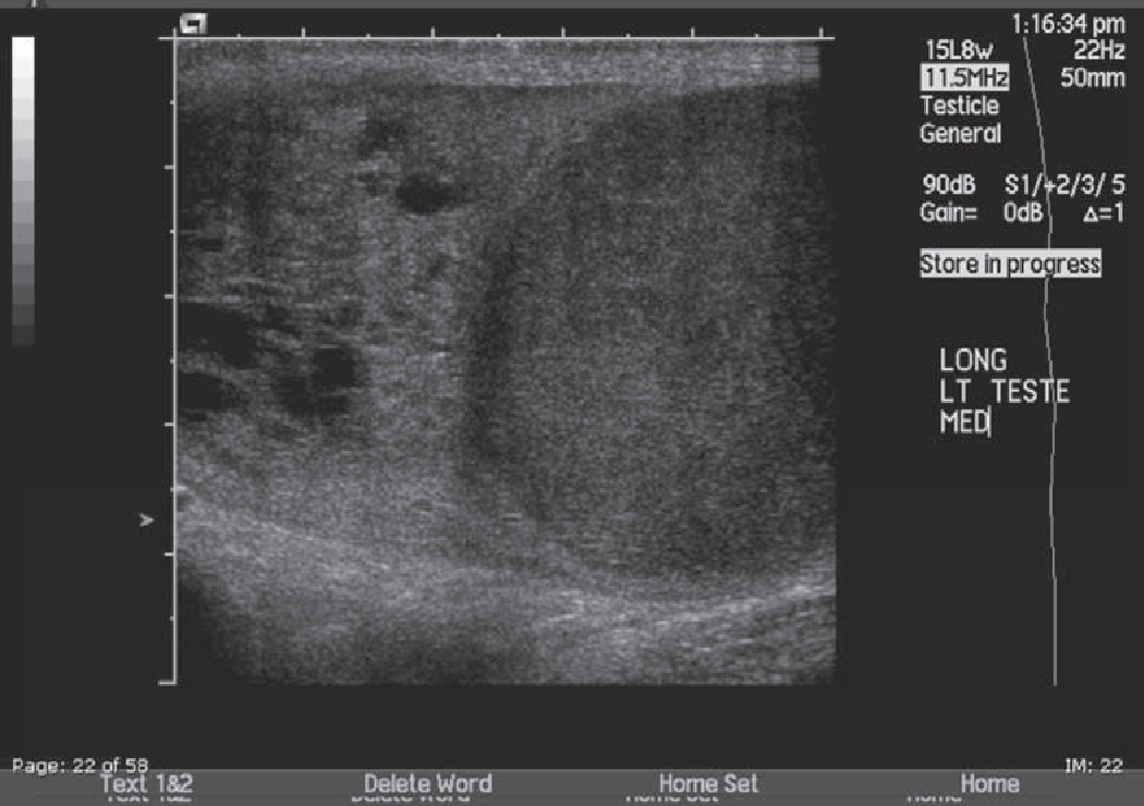 Figure 2 From Testicular Tumor Ultrasound Characteristics And