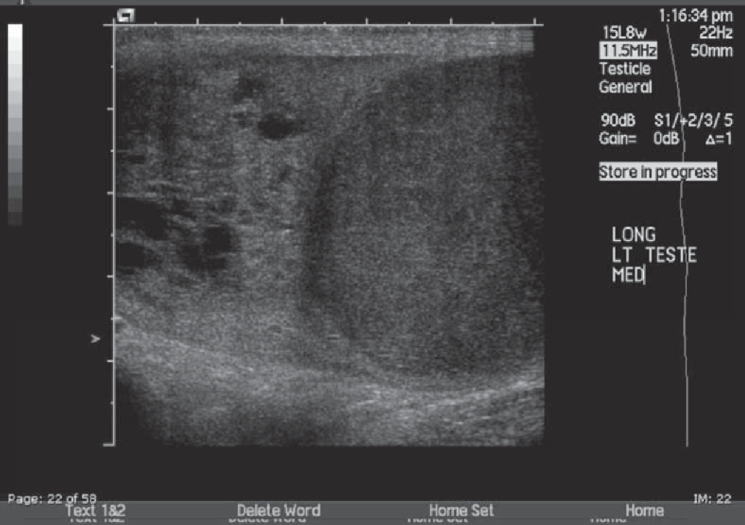 Testicular Tumor Ultrasound Characteristics And Association With