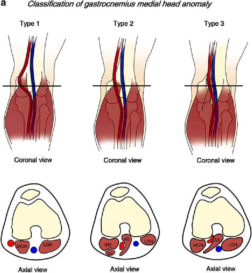 Popliteal Artery Entrapment Syndrome Wikipedia