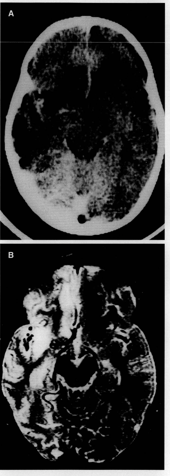 Figure 1 From Rasmussen Encephalitis Associated With Segmental Vitiligo