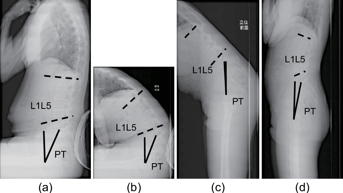 Figure 1 From Radiographic Assessment Of Spinopelvic Sagittal Alignment