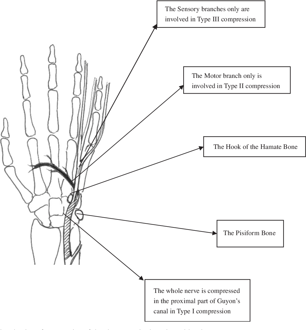 Ulnar Nerve Entrapment Syndrome