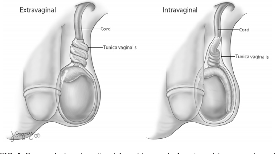 Figure 1 From Aua Update Series Lesson 12 Volume 28 2009 Testicular