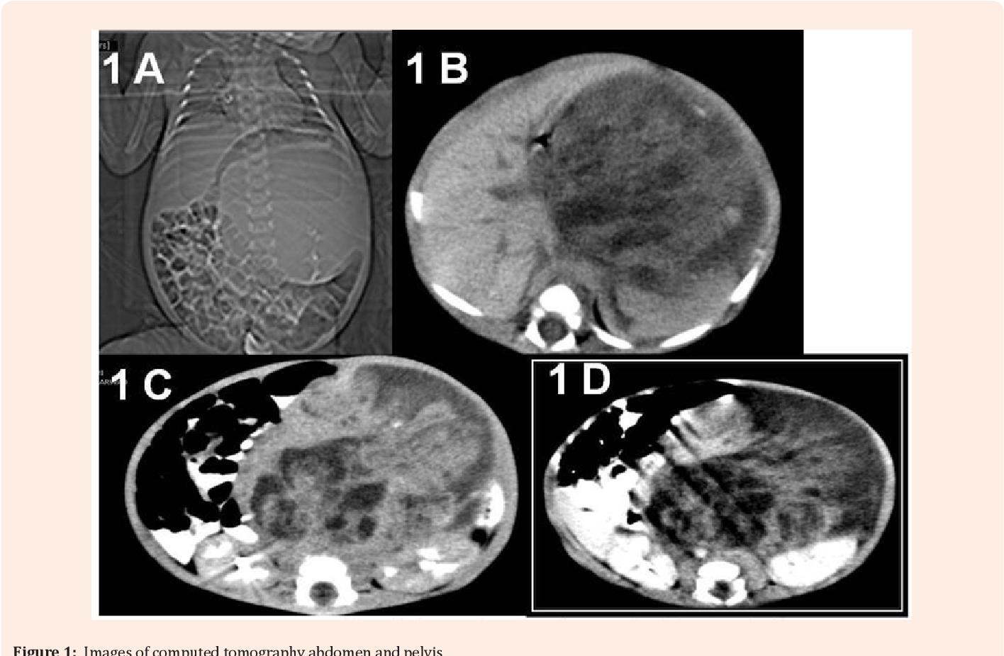 Figure 1 From Giant Retroperitoneal Mature Cystic Teratoma In An Infant