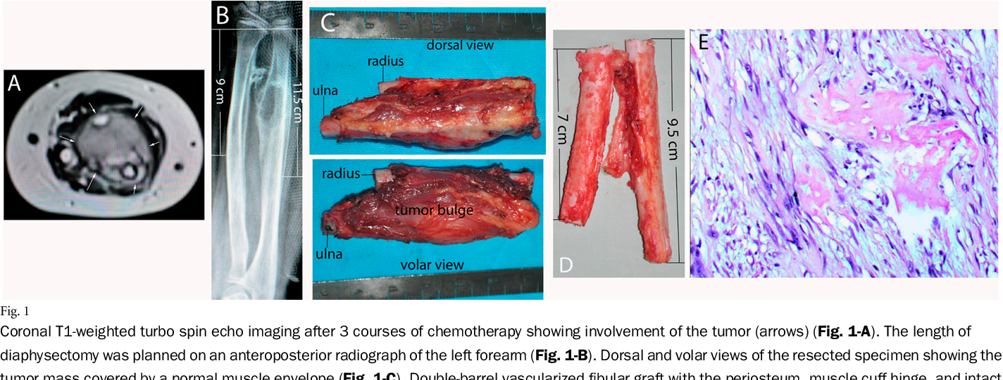 Figure 1 From Free Double Barrel Vascularized Fibular Graft For Two