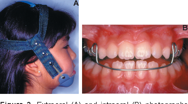 Class Iii Malocclusion Treatment Options Gertude Sauls