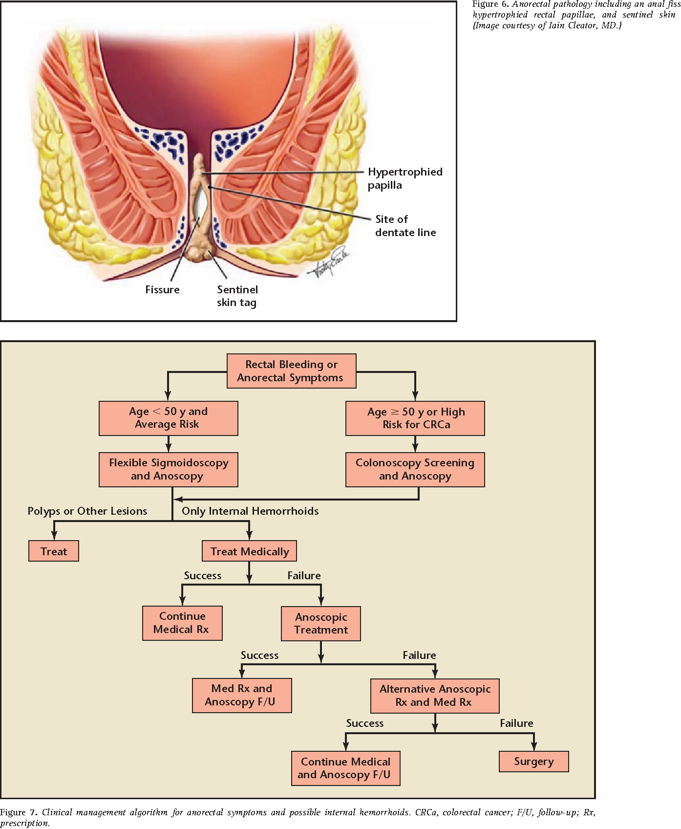 Definitive Therapy For Internal Hemorrhoids New Opportunities And