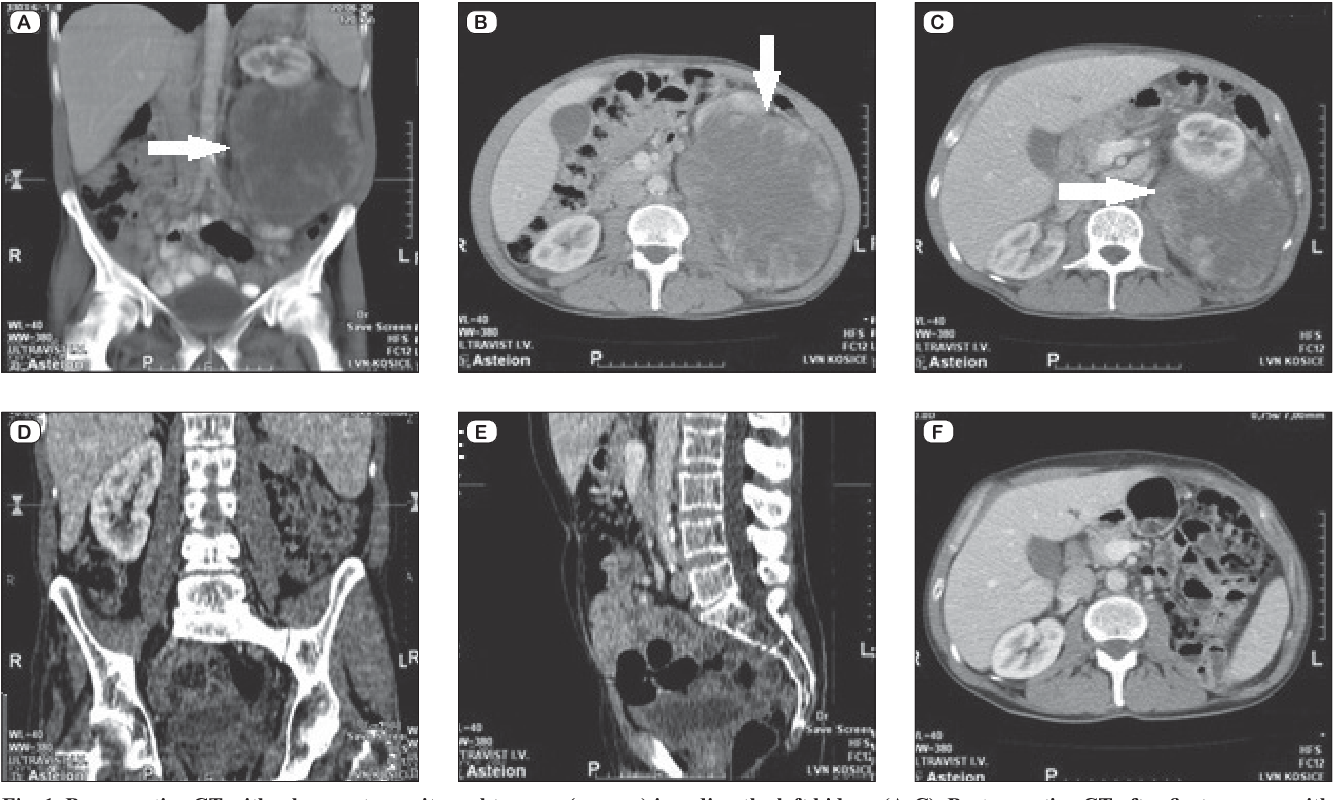 Figure 2 From The Recurrent Primary Retroperitoneal Liposarcoma