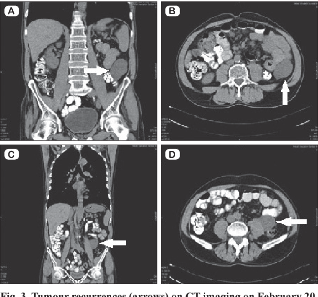 Figure 2 From The Recurrent Primary Retroperitoneal Liposarcoma