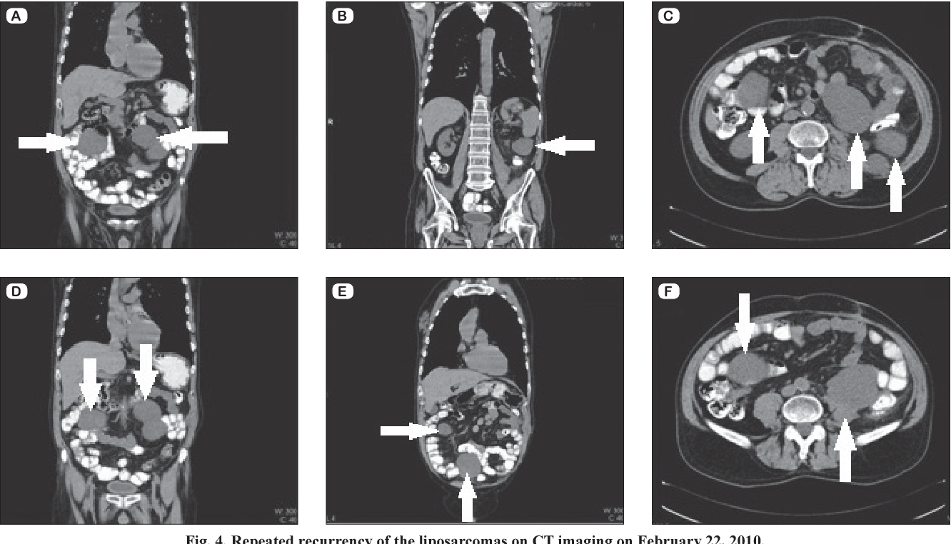 Figure 2 From The Recurrent Primary Retroperitoneal Liposarcoma