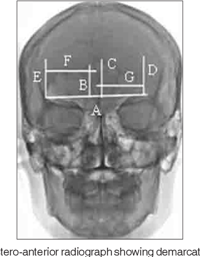 Figure 1 From Assessment Of Frontal Sinus Dimensions To Determine
