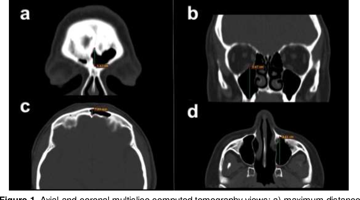 Table 1 From The Application Of Frontal And Maxillary Sinuses Indices