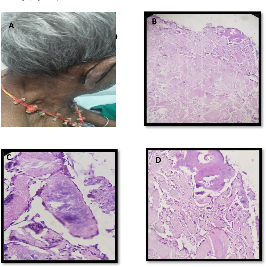 Figure 1 From Spectrum Of Various Skin Nodule Mimicking Cutaneous