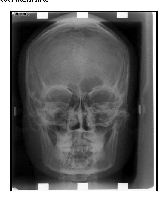 Table 1 From Unleash The Unknown Frontal Sinus And Nasal Septal