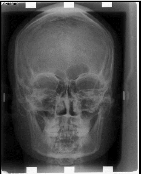 Unleash The Unknown Frontal Sinus And Nasal Septal Patterns In