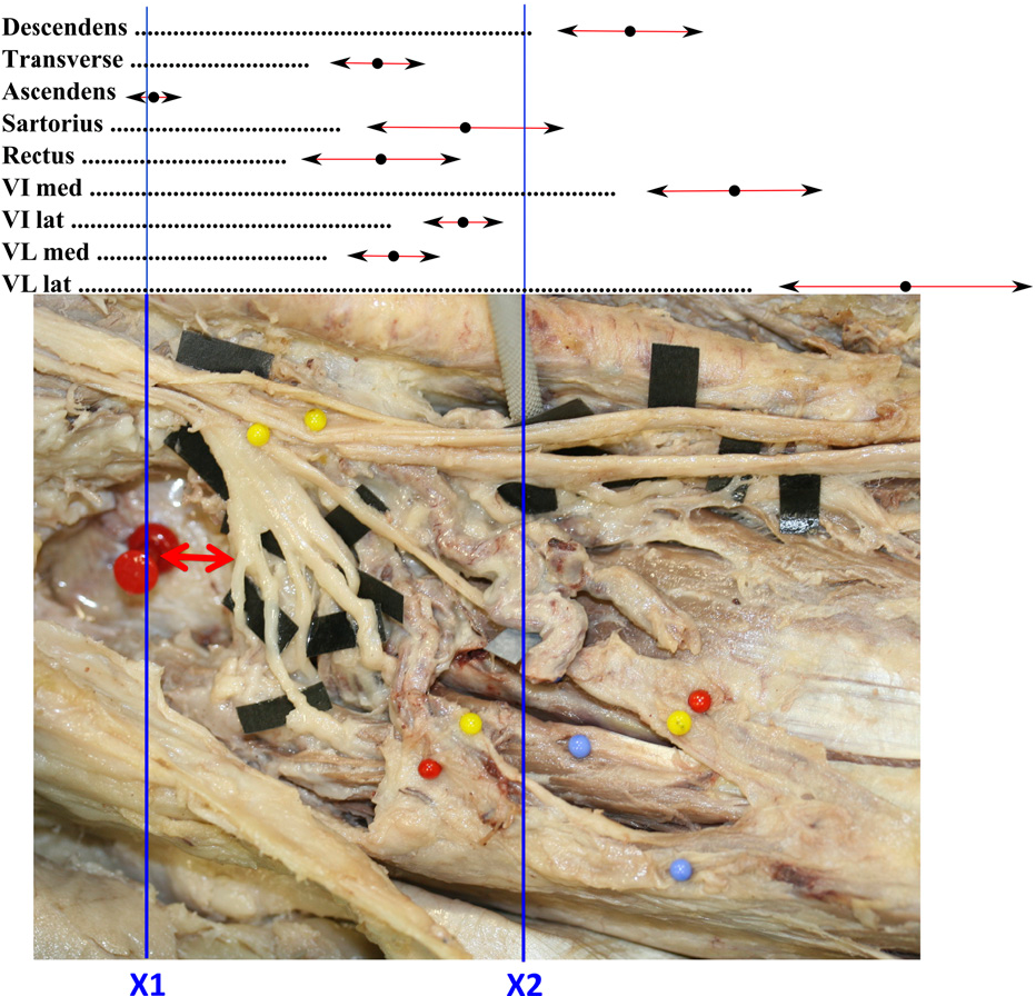 Figure 3 From Distal Extension Of The Direct Anterior Approach To The