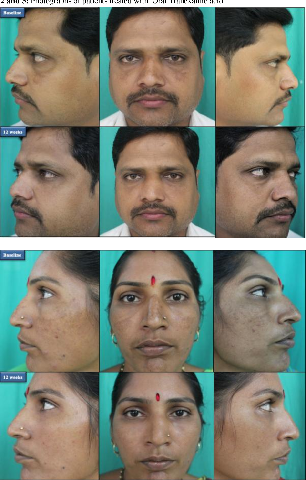 Figure 4 From Safety And Efficacy Profile Of Oral Tranexamic Acid Vs