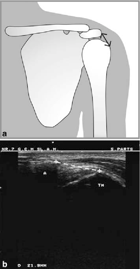 Subacromial Impingement Syndrome Diagnosis Management Images And