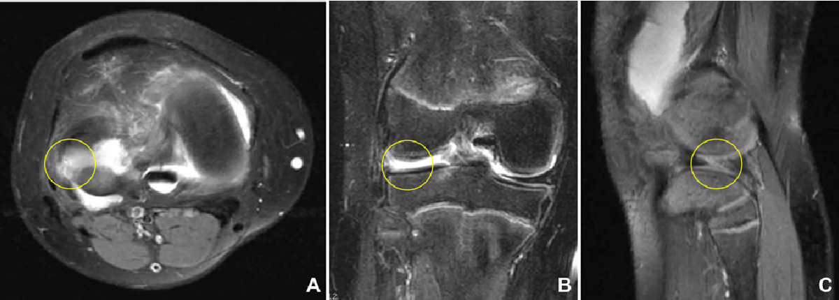 Figure 1 From Reliability Of Mri Interpretation Of Discoid Lateral