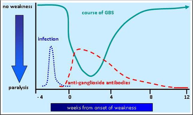 Figure 1 From Diagnosis Treatment And Prognosis Of Guillain Barré