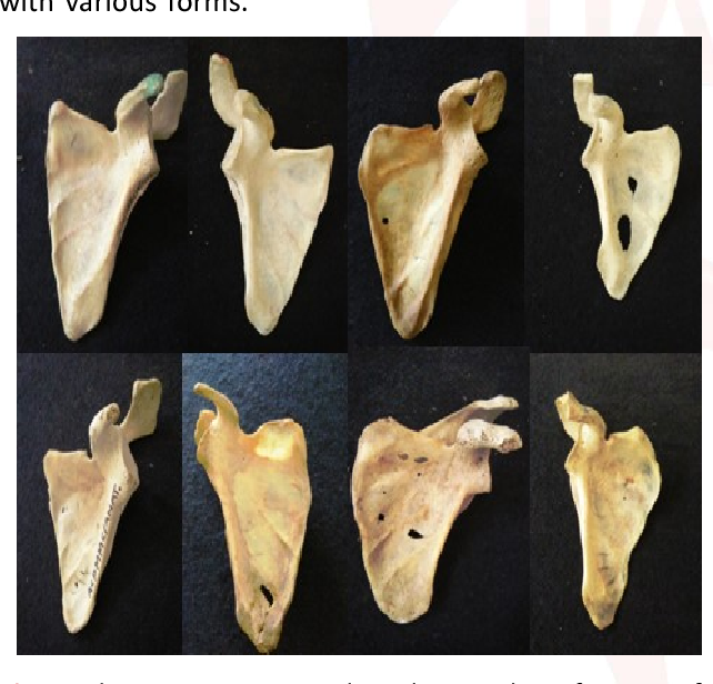 Figure 1 From Morphological Variations Of The Suprascapular Notch