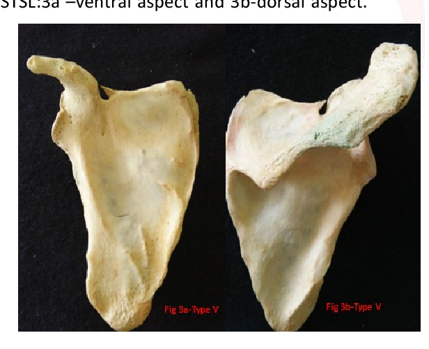 Figure 1 From Morphological Variations Of The Suprascapular Notch