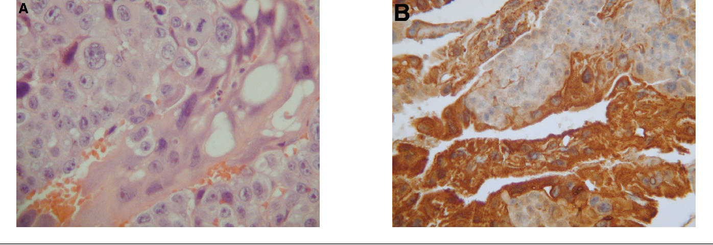 Figure 1 From Uterine Gestational Choriocarcinoma Developing After A