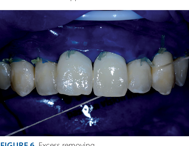 Figure 5 From Treatment Of Post Orthodontic White Spot Lesions By Resin