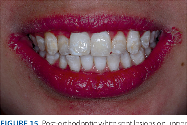 Figure 3 From Treatment Of Post Orthodontic White Spot Lesions By Resin