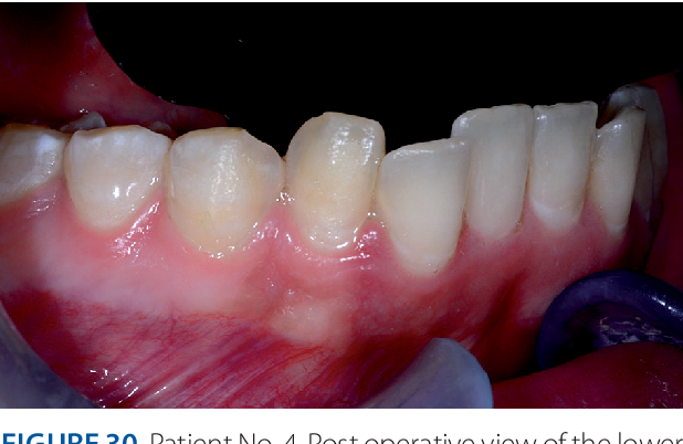 Figure 3 From Treatment Of Post Orthodontic White Spot Lesions By Resin