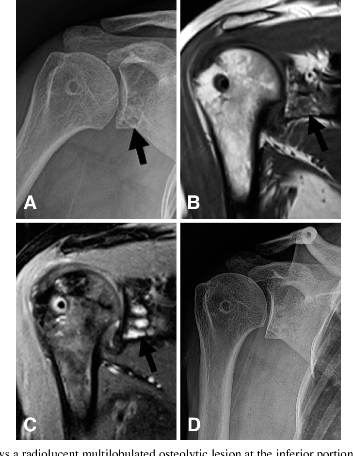 Figure 2 From Symptomatic Benign Intraosseous Osteolytic Lesions Of The