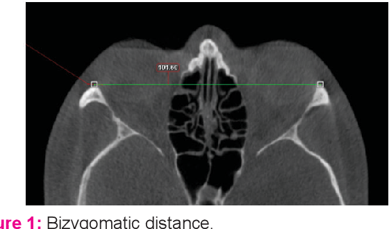 Figure 1 From Bizygomatic Distance And Maxillary Sinus Dimensions As