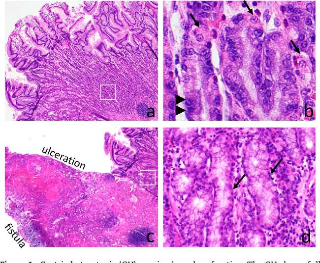 Figure 1 From Gastric Heterotopia With Perforation Mimicking Neoplastic