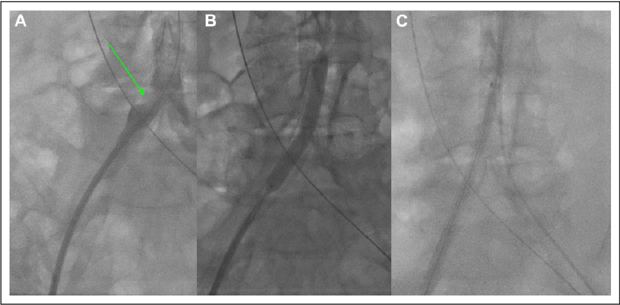 Figure 2 From Shockwave Intravascular Lithotripsy For The Treatment Of