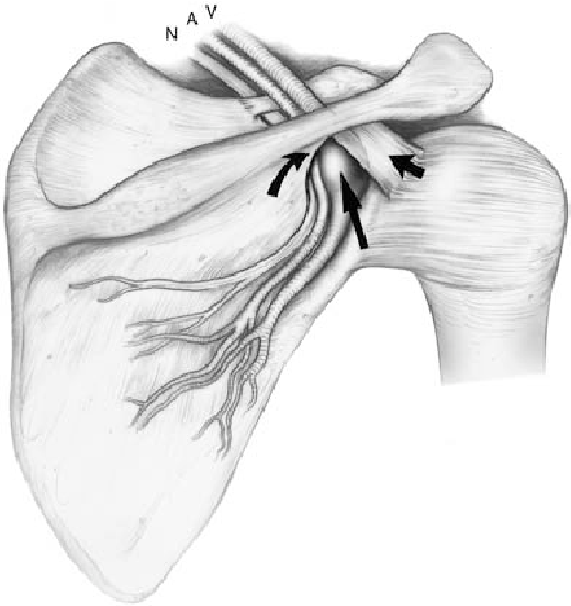 Enlarged Spinoglenoid Notch Veins Causing Suprascapular Nerve