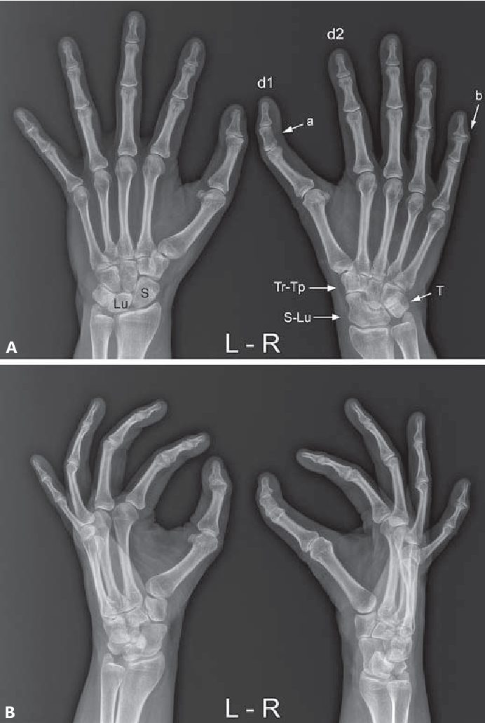 Figure 1 From Novel Marfan Syndrome Associated Mutation In The Fbn1