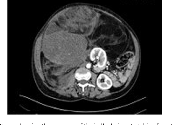 Figure 1 From Giant Retroperitoneal Liposarcoma Case Report And Review