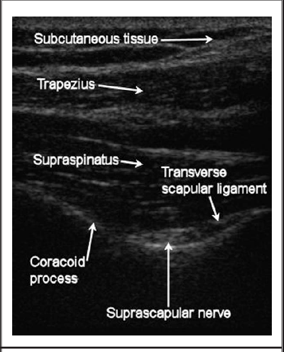 Suprascapular Nerve Block Ultrasound