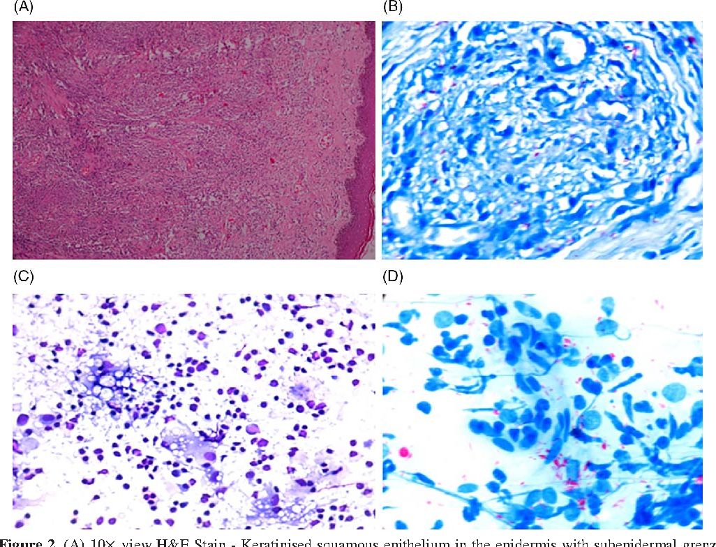 Figure 1 From Genital Lepromatous Leprosy With Bilateral Inguinal