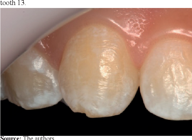 Figure 1 From Use Of Resin Infiltrate For The Treatment Of White Spot