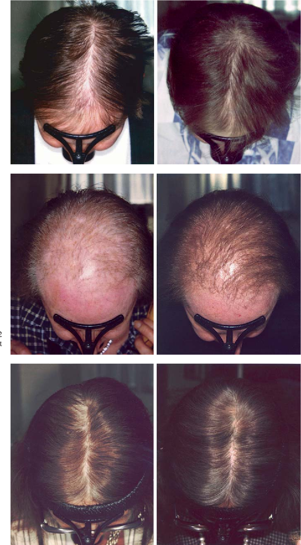 Share 134 Finasteride Male Pattern Hair Loss Poppy