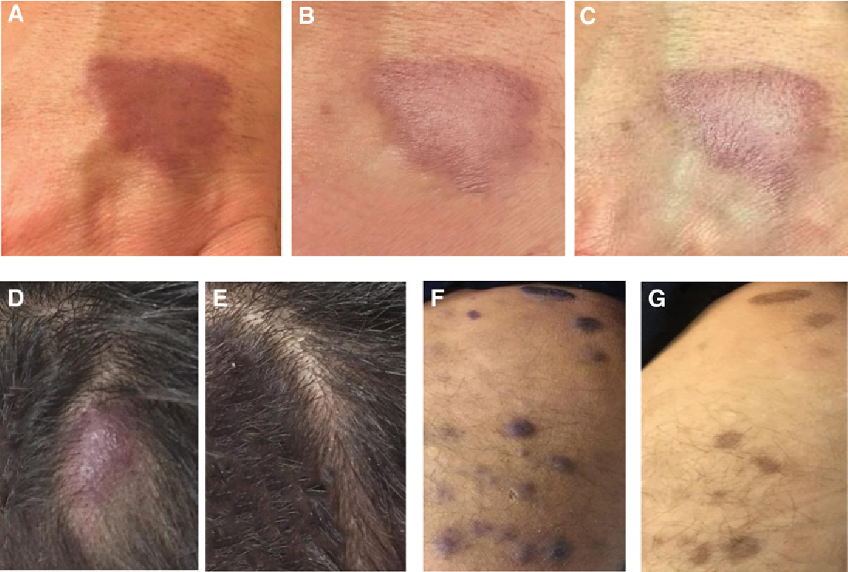 Pdf Successful Treatment Of Hiv Associated Kaposi Sarcoma With Immune