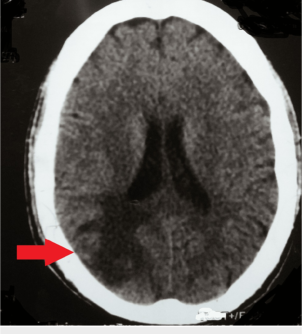 Figure 1 From Extrapulmonary Tuberculosis Presenting As Stage V