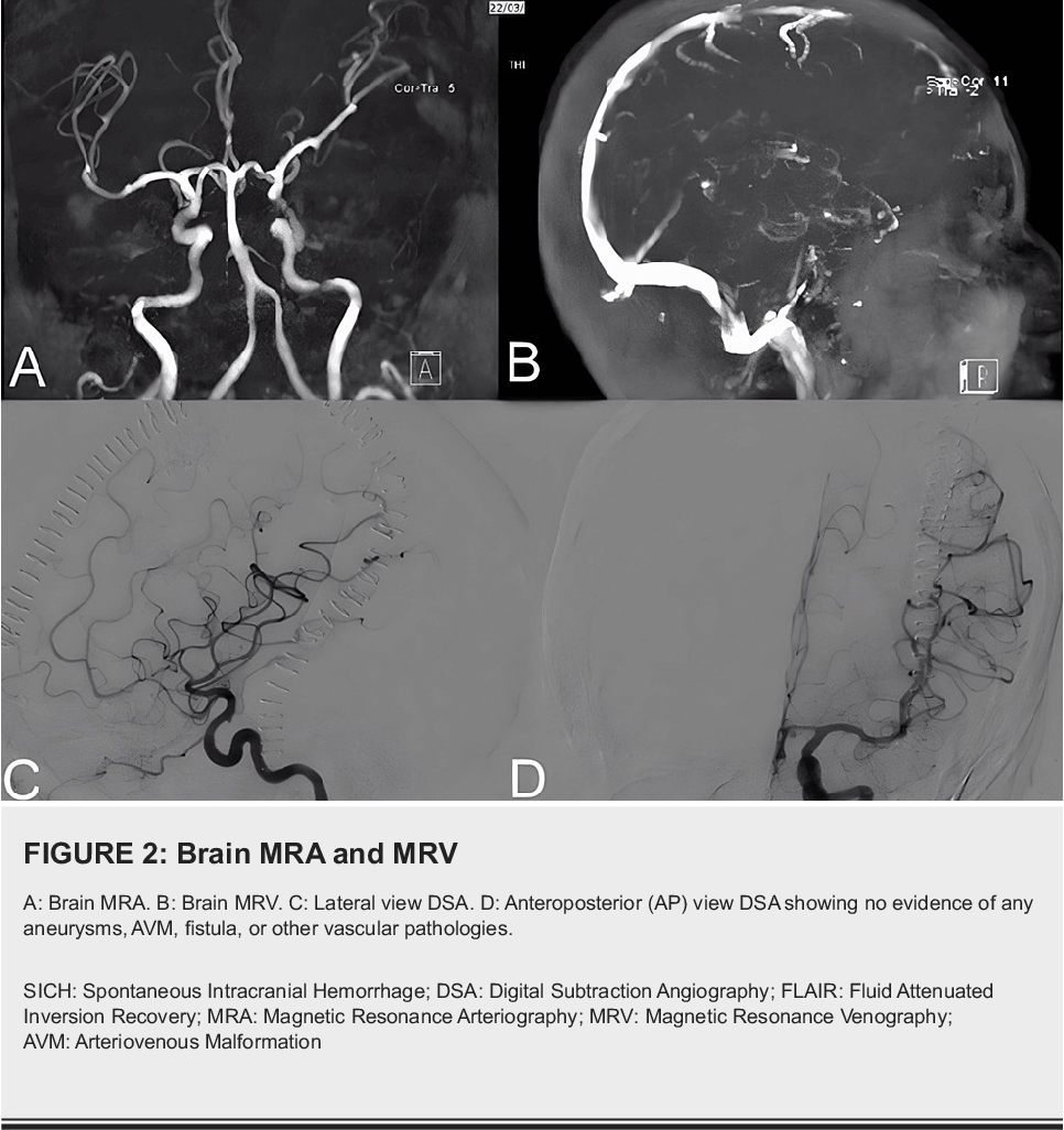 Figure 1 From Spontaneous Intracranial Hemorrhage Concurrent With